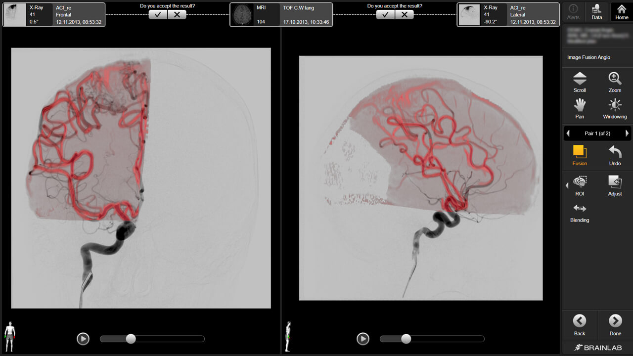 Kraniale Planung mit den Elements | Brainlab